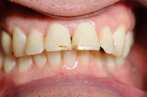 Crowns | Falls Family Dental