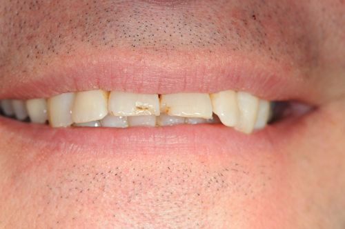 Crowns | Falls Family Dental